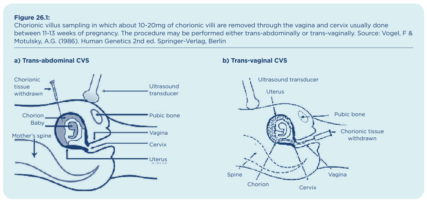 Chorionic Villus Sampling Diagram