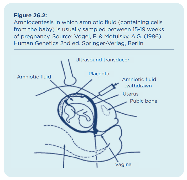 Chorionic Villus Sampling Diagram Prenatal Screening & Fetal Testing