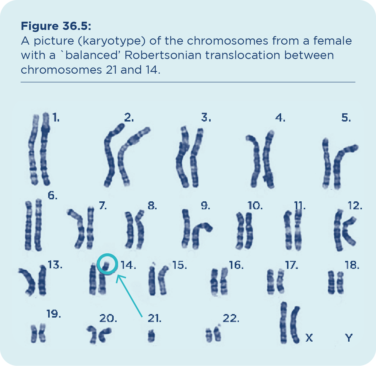 Translocation Down Syndrome