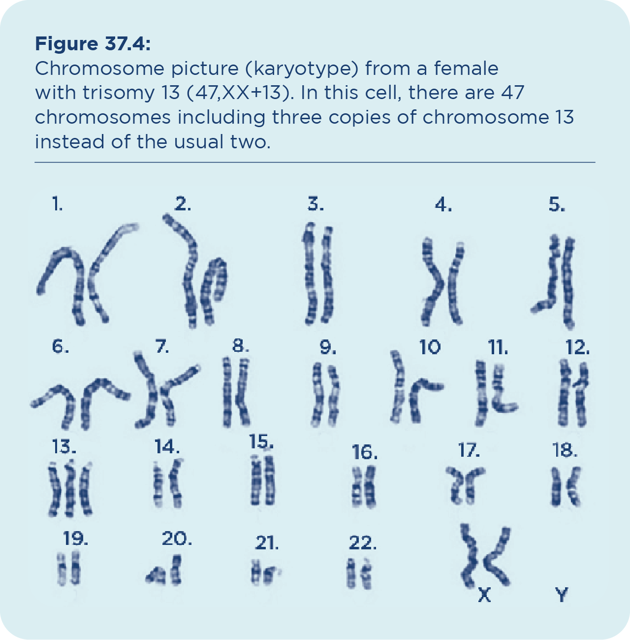 Patau Syndrom Karyotype Karyotype Test Purpose And Steps