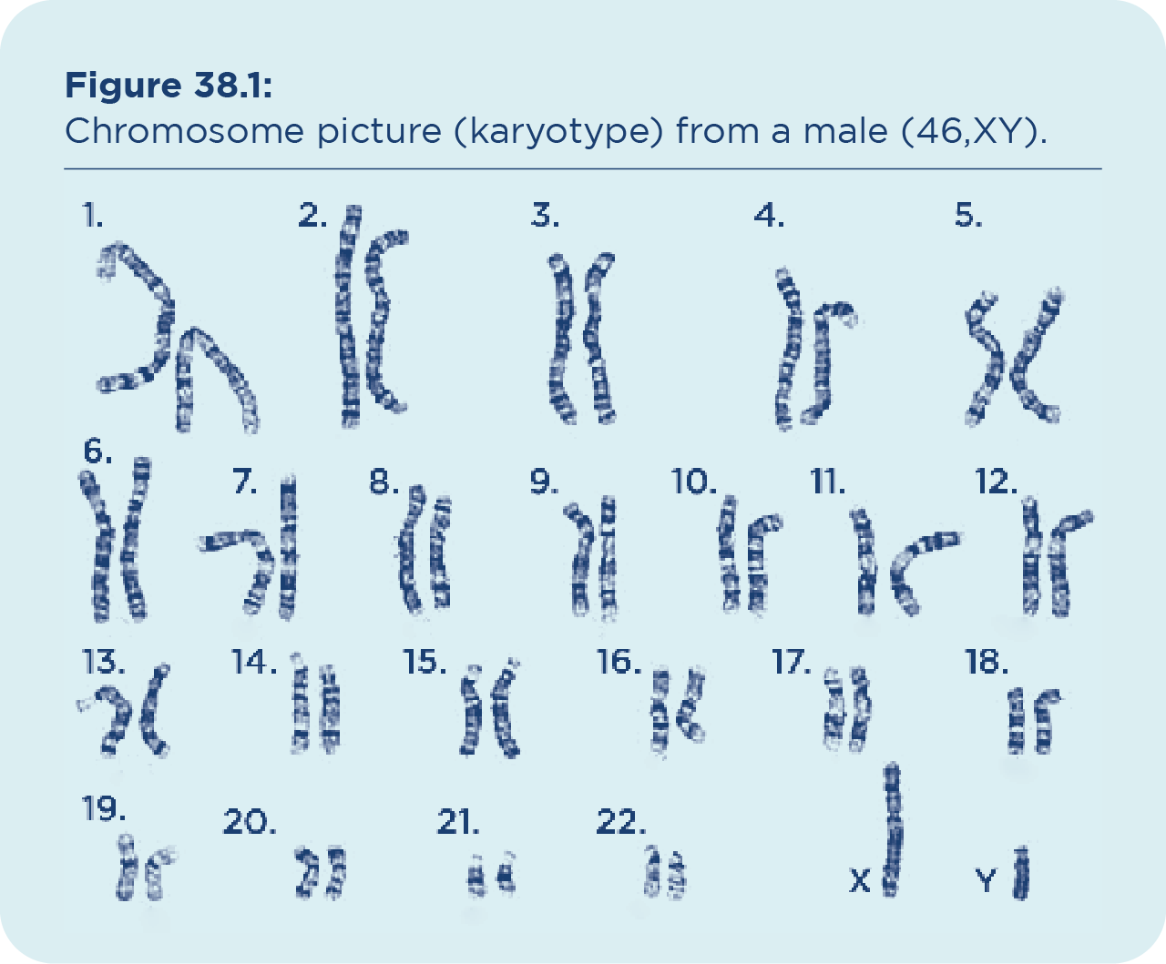 Edwards Syndrome Karyotype Stock Photo 80335266 Alamy