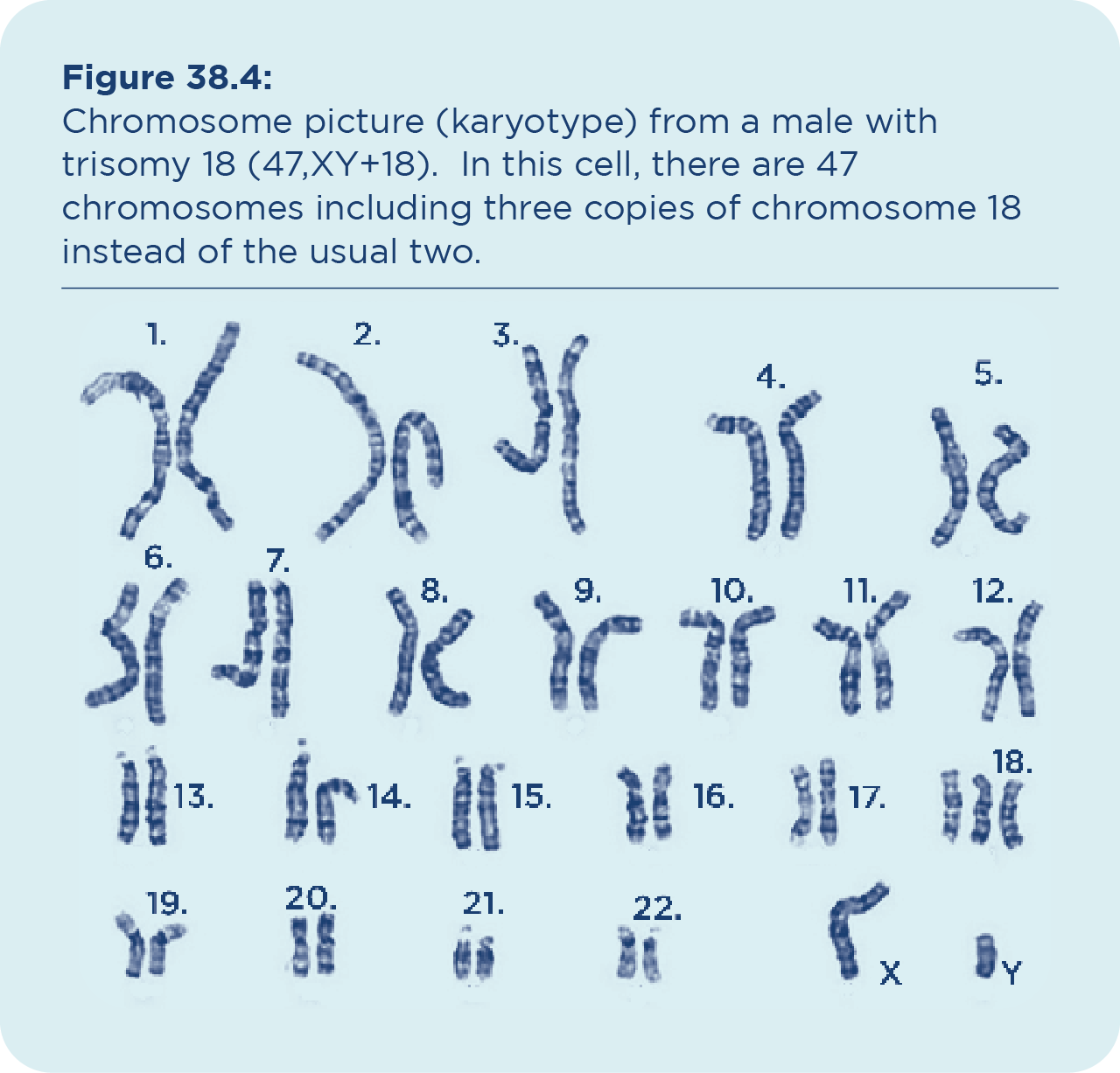 Trisomy Chromosome